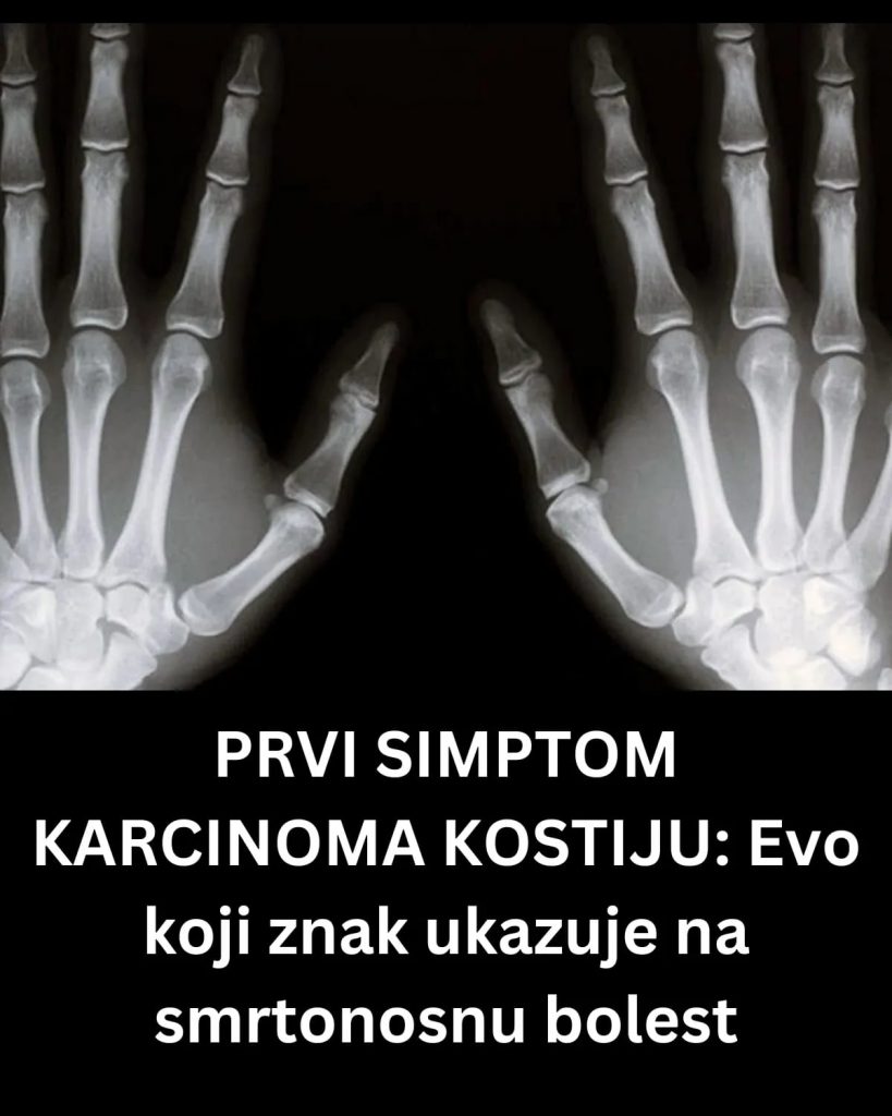 PRVI SIMPTOM KARCINOMA KOSTIJU: Evo koji znak ukazuje na smrtonosnu ...